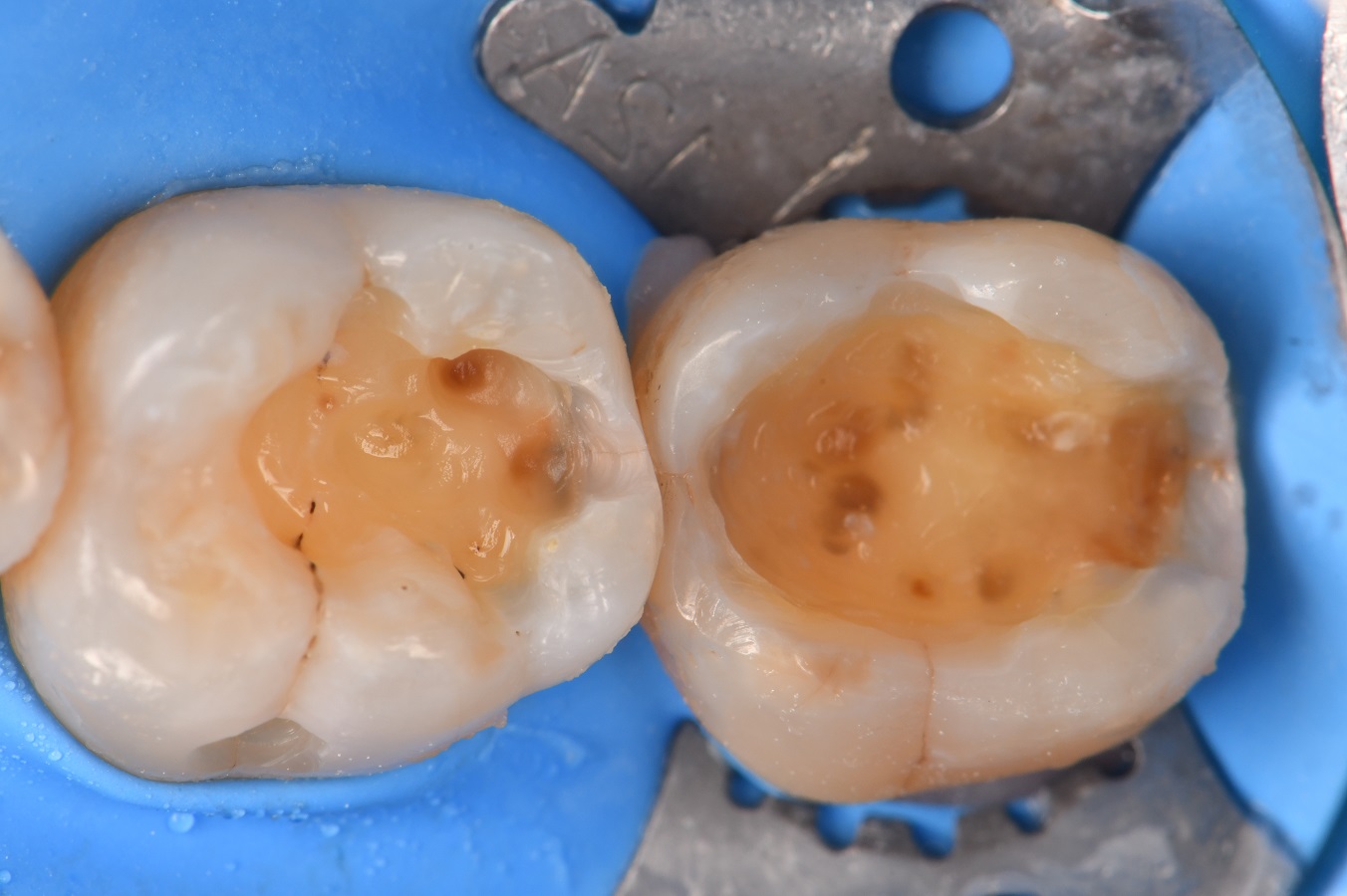Fissure anatomy on a lower second molar