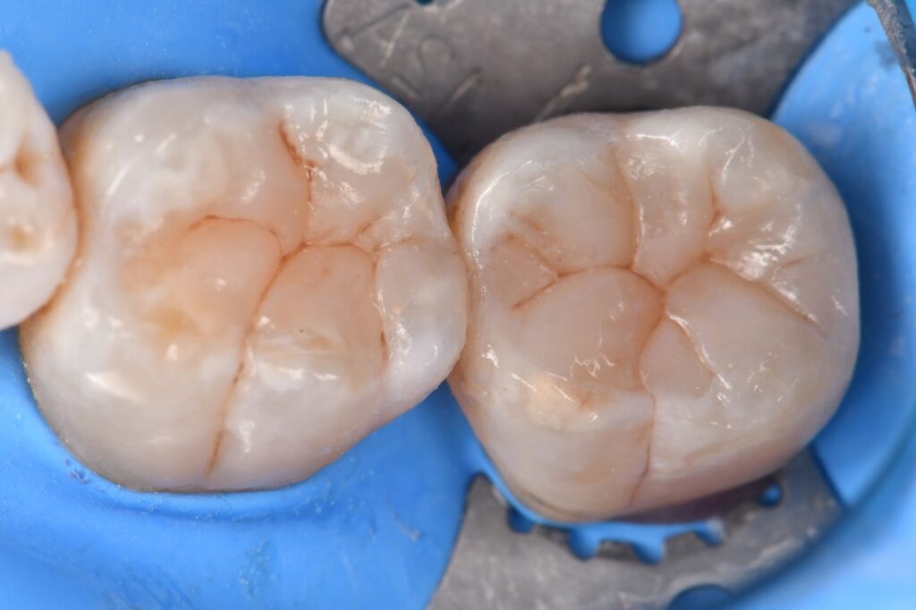 Fissure anatomy on a lower second molar
