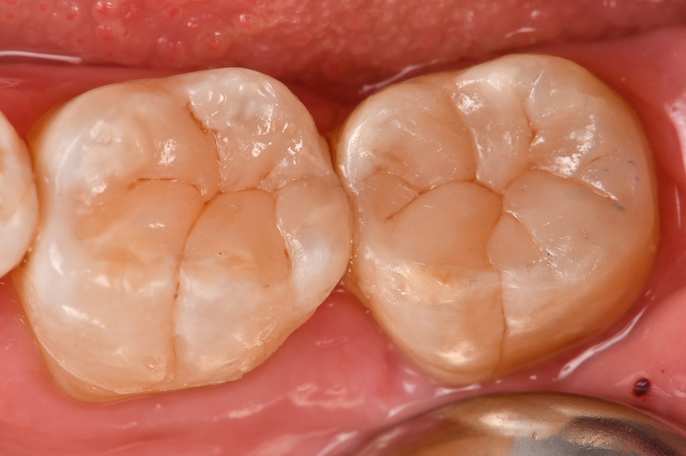 Fissure anatomy on a lower second molar