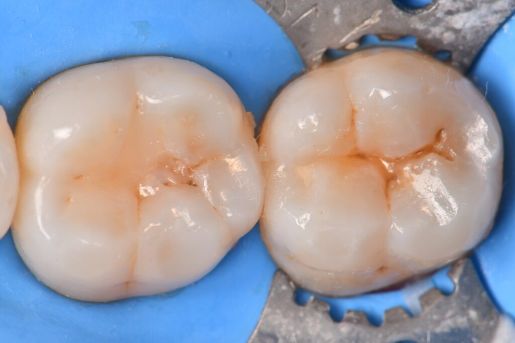Fissure caries can be quite deep