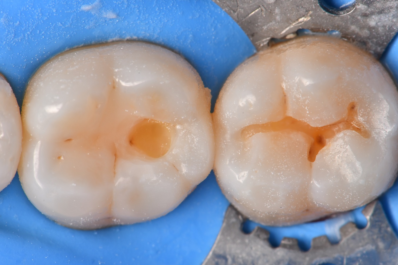 Fissure caries can be quite deep