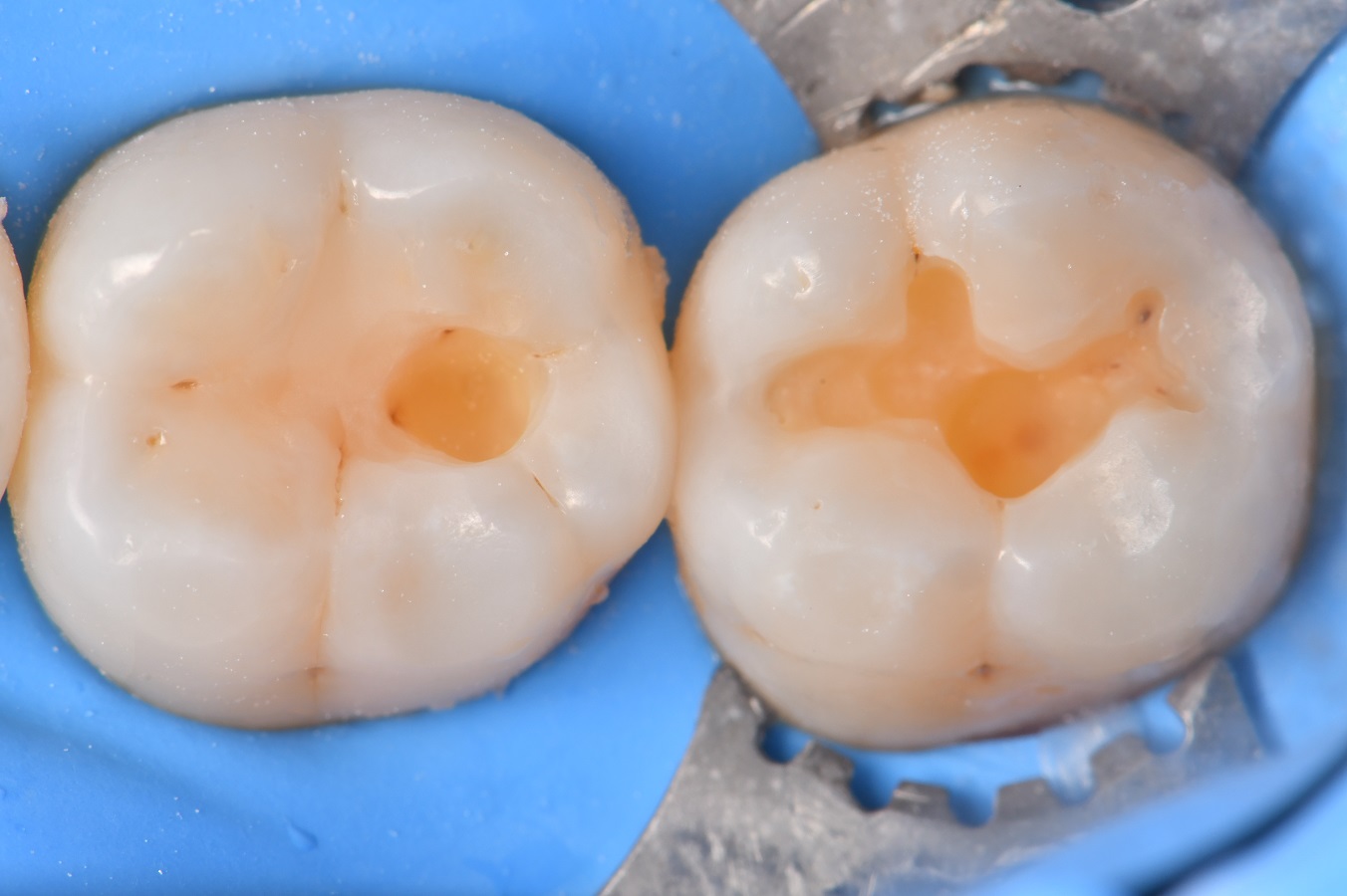 Fissure caries can be quite deep
