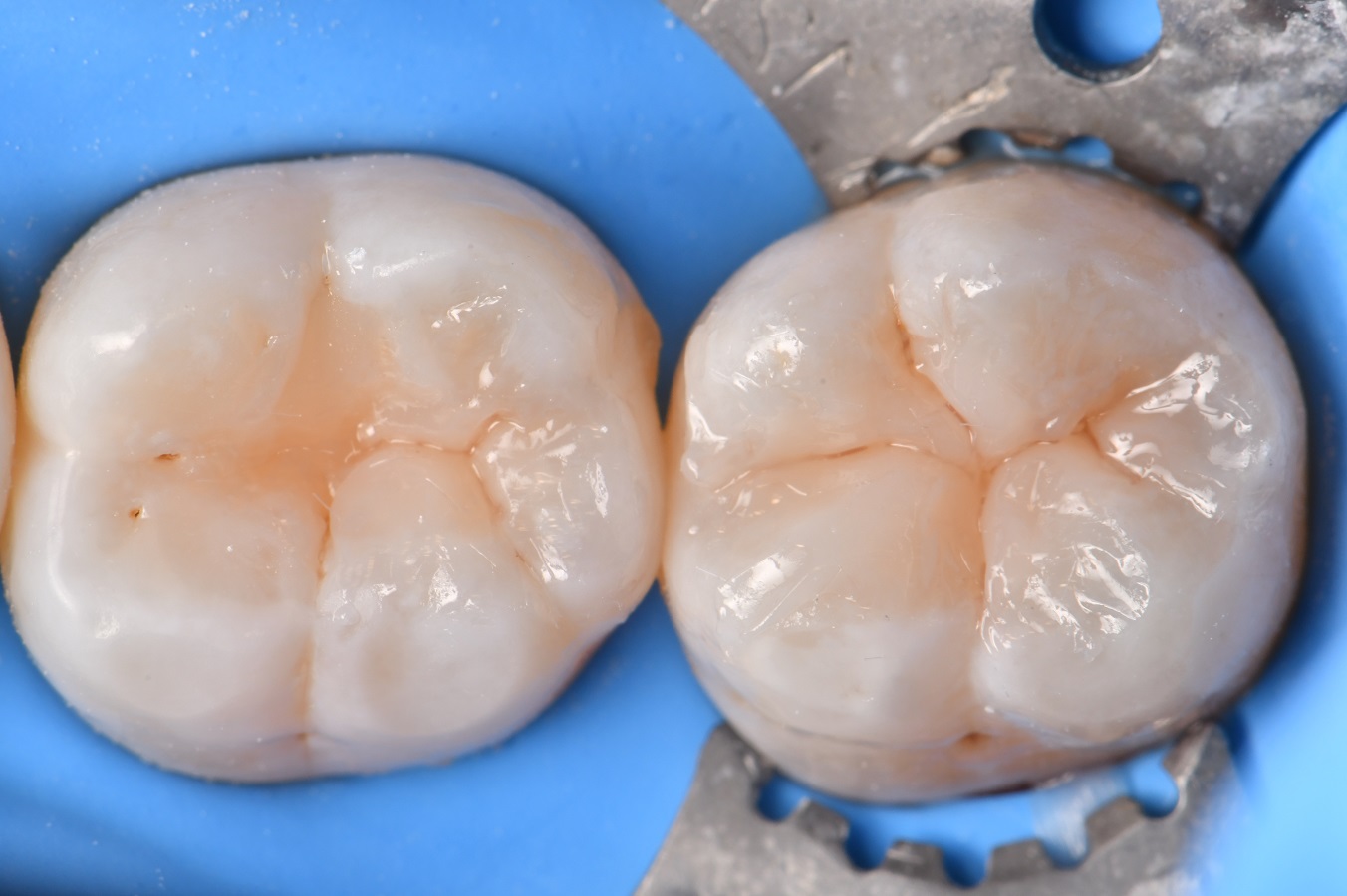 Fissure caries can be quite deep