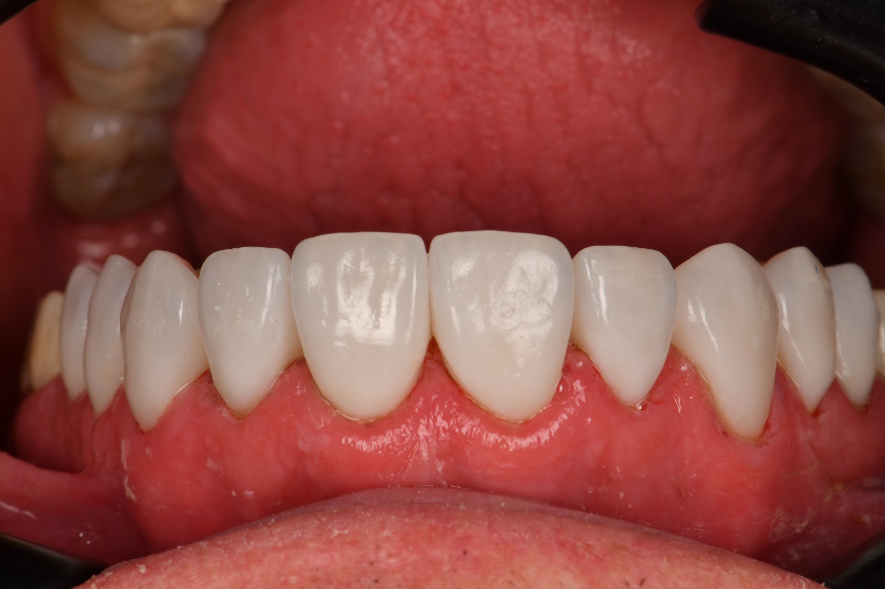 Digital Smile Design-driven Esthetic reconstruction