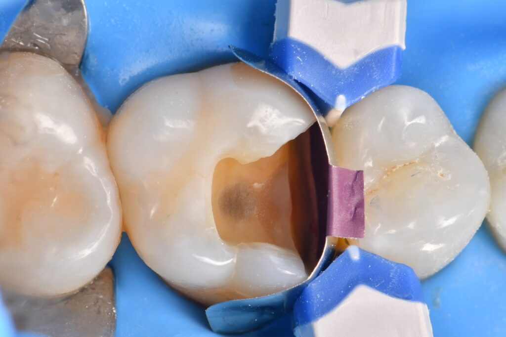 Class II direct composite workflow with Ever-X and Garrison