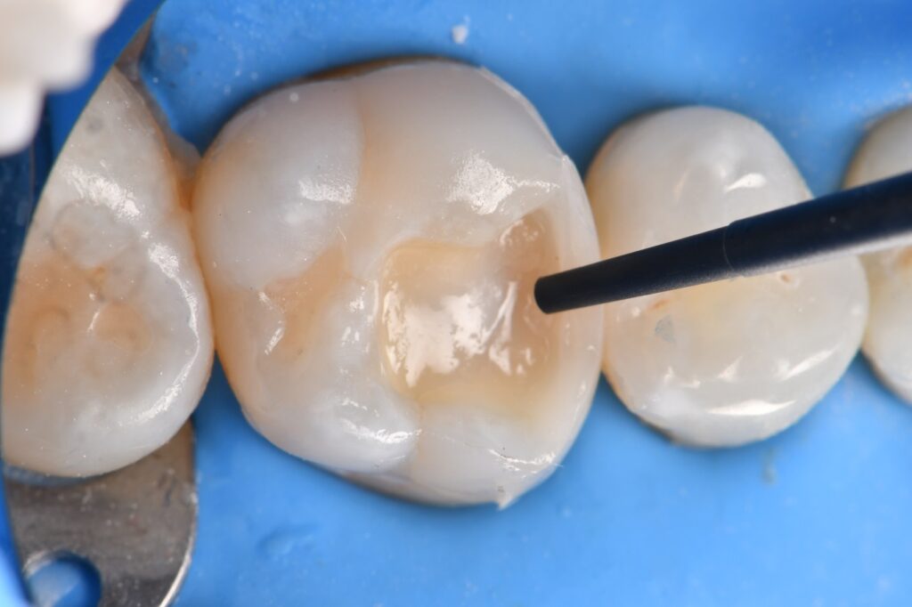 Class II direct composite workflow with Ever-X and Garrison