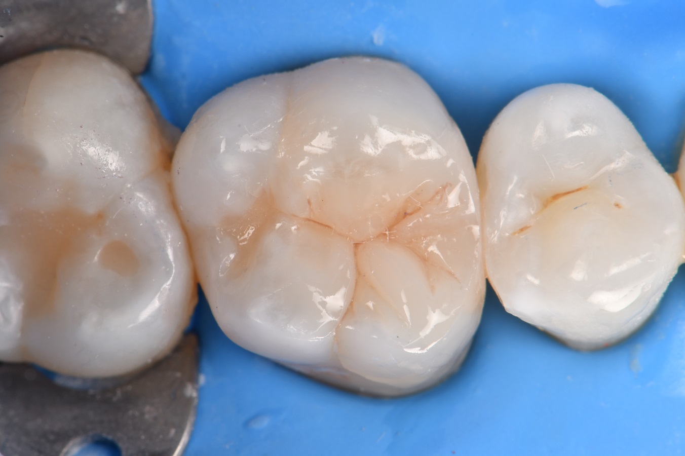 Class II direct composite workflow with Ever-X and Garrison