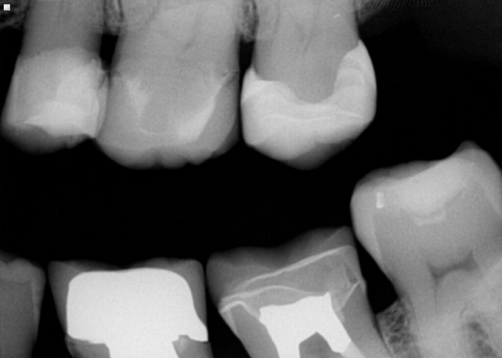 Deep Margin Elevation Tip