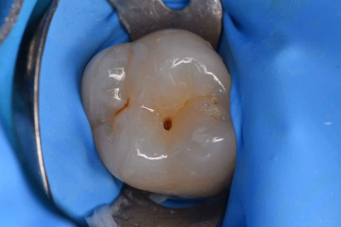 Small Occlusal Composite Restorations