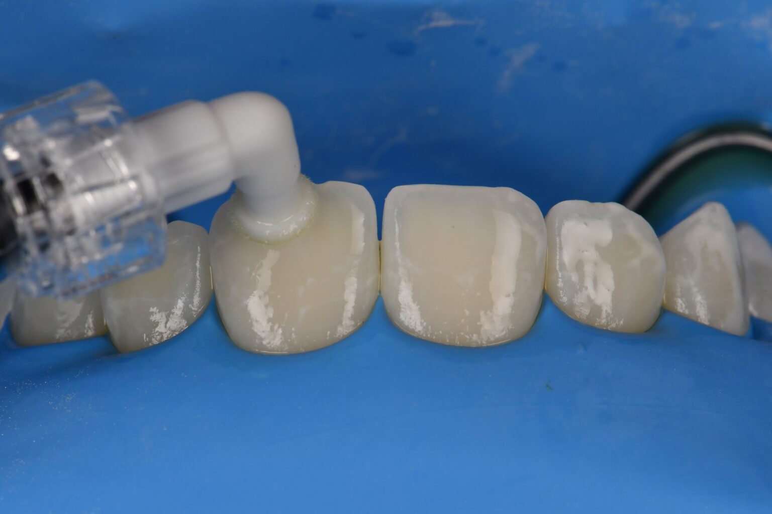 Non Invasive Resin Infiltration on a 13 year old female