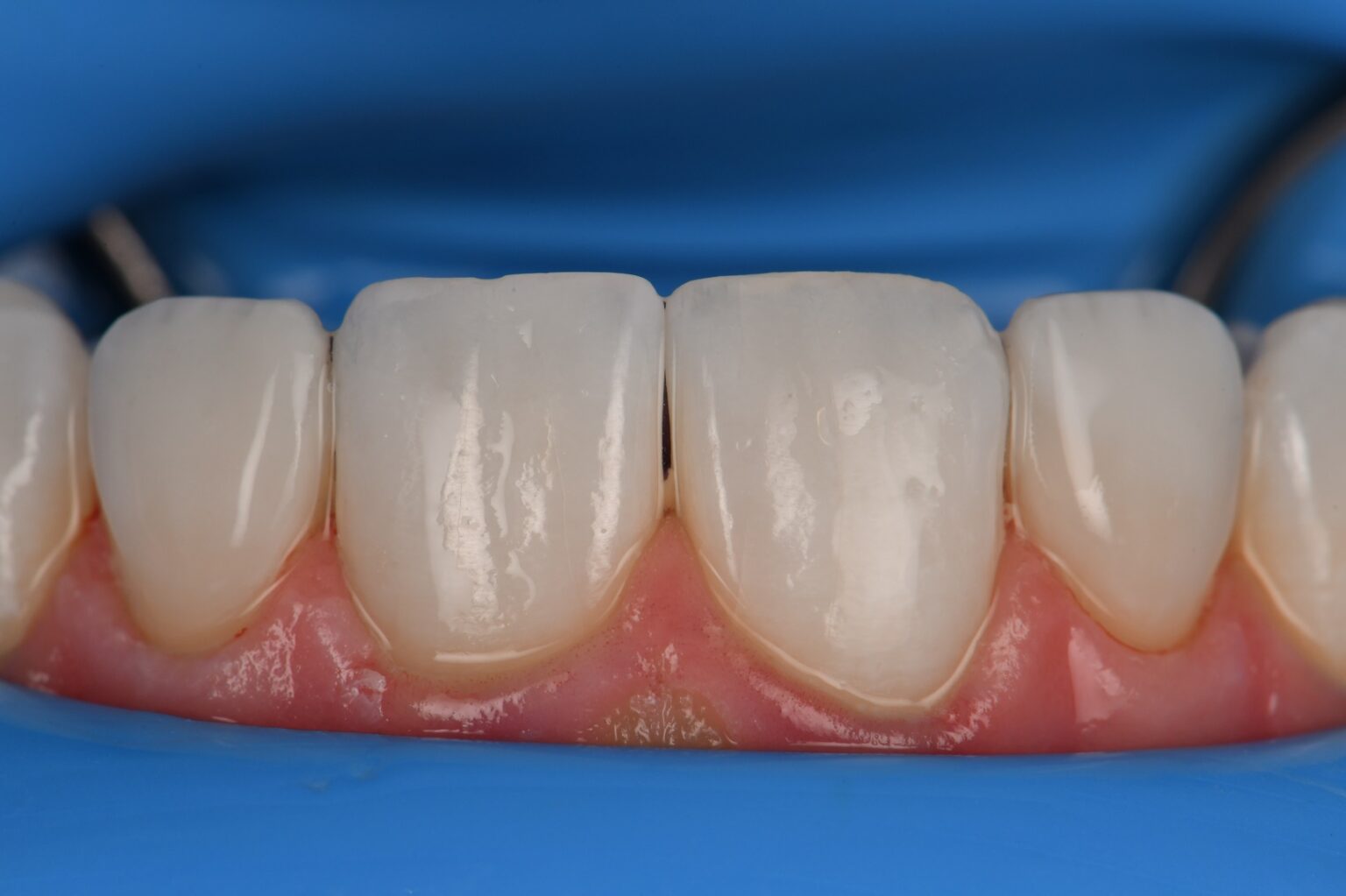 Partial Additions to Short Lateral Incisors