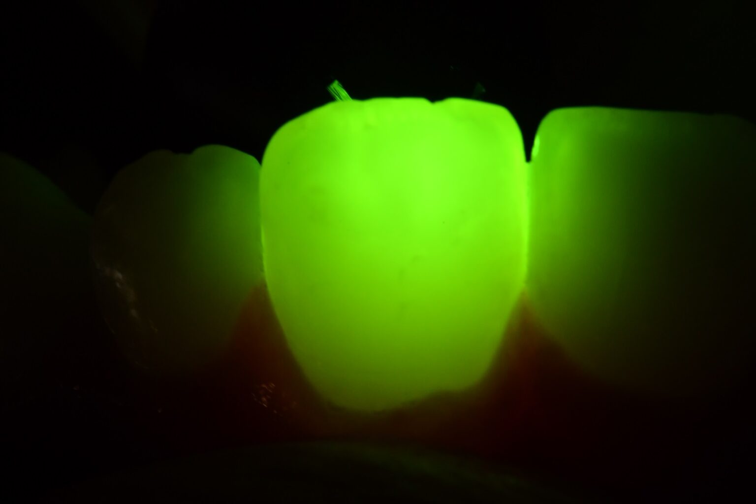 Non Invasive Resin Infiltration on a 13 year old female