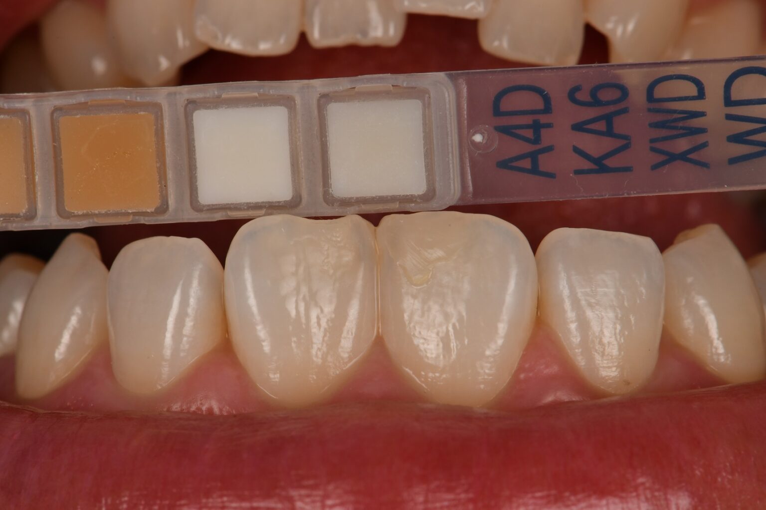 Crown Lengthening and Composite Veneers
