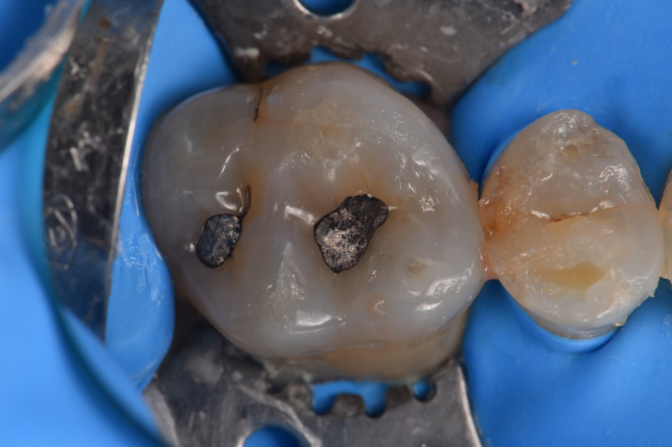 Class I dental cavity intricate anatomy