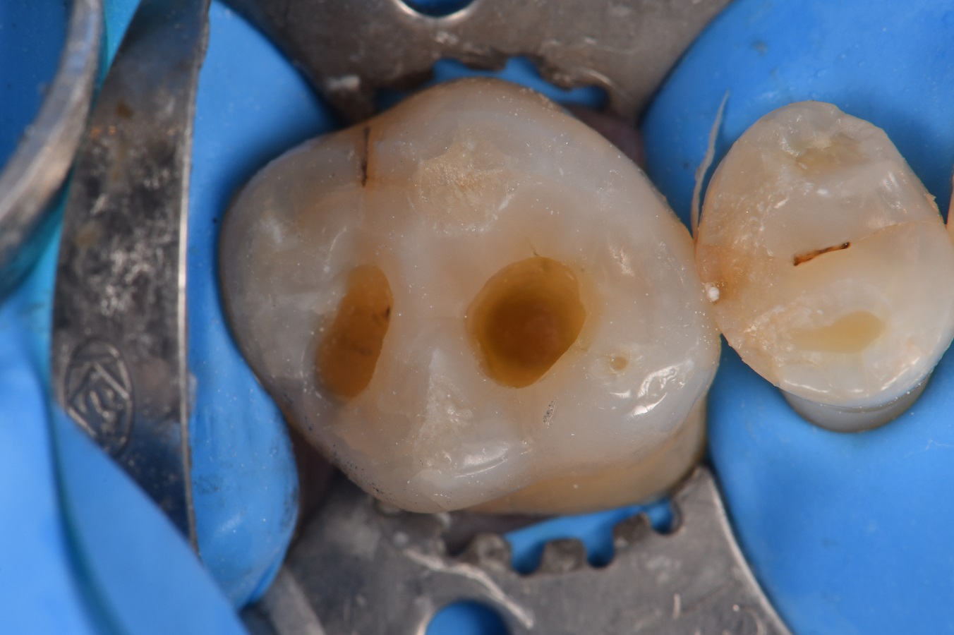 Class I dental cavity intricate anatomy