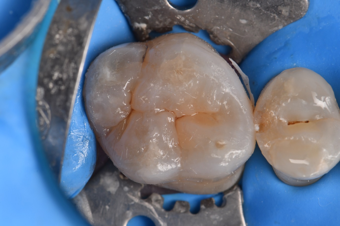 Class I dental cavity intricate anatomy