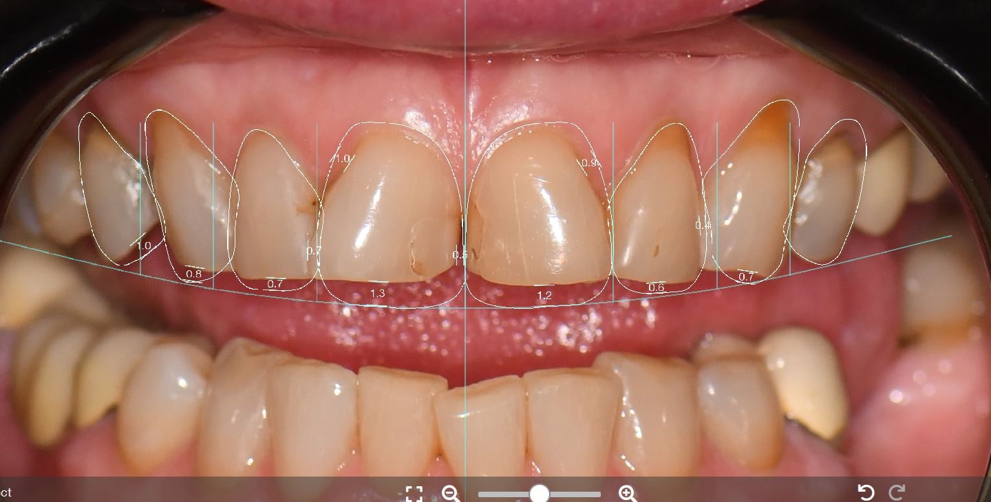 Smile Design translates to predictable clinical results