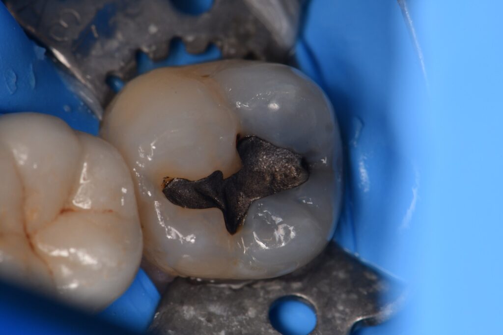 Workflow for rebuilding a cracked second molar