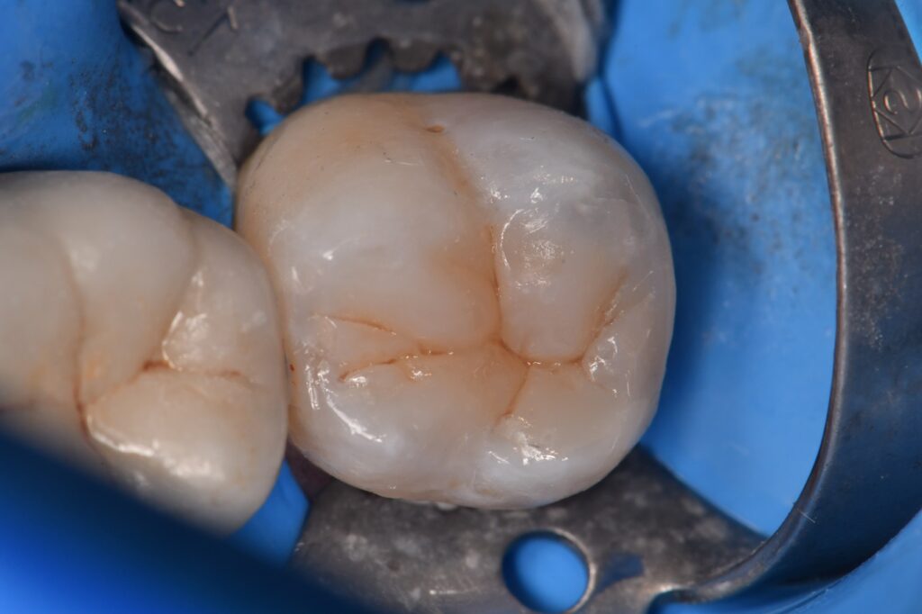 Workflow for rebuilding a cracked second molar