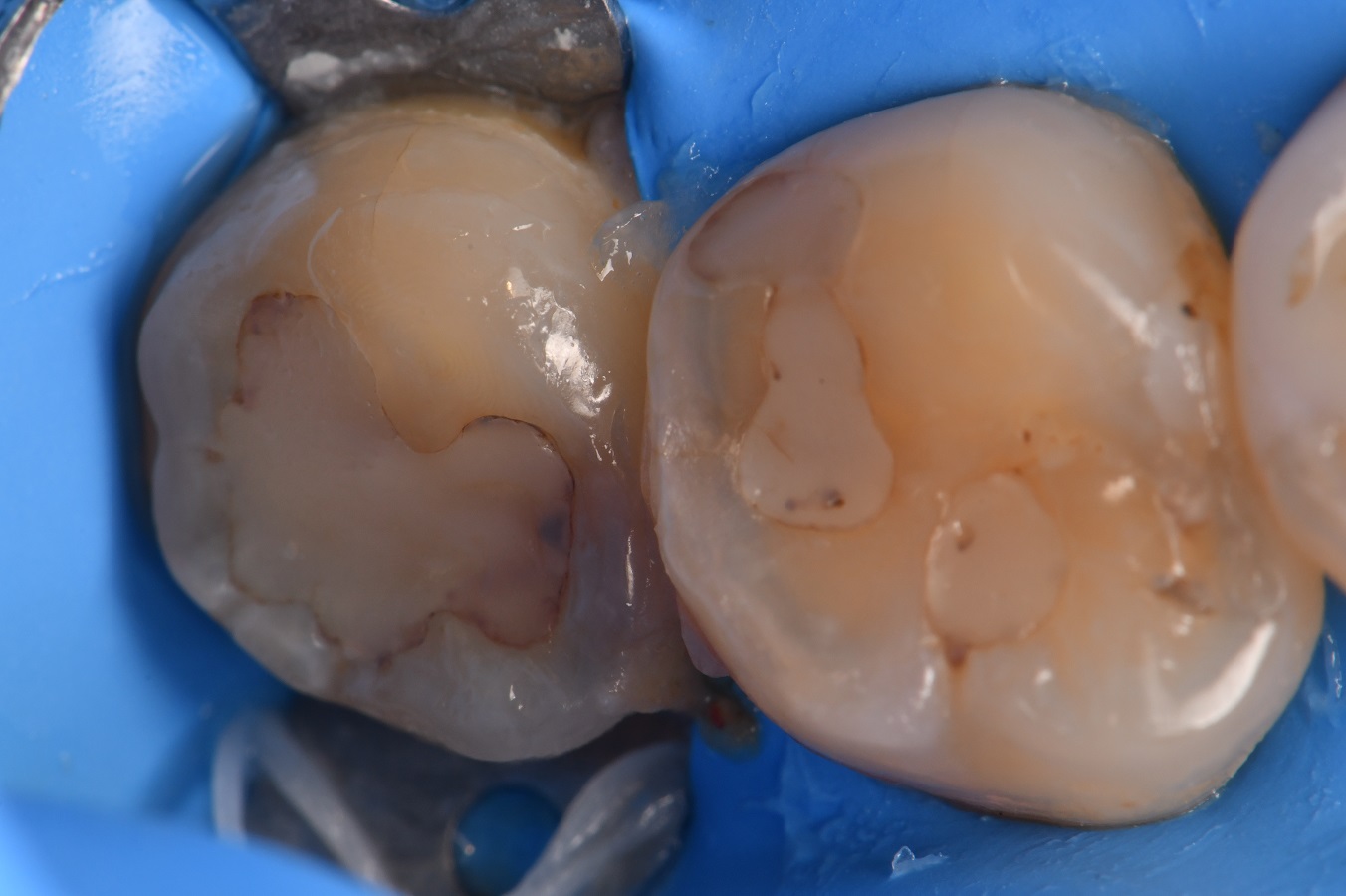 Supercomposite Partial Coverage Direct Restoration