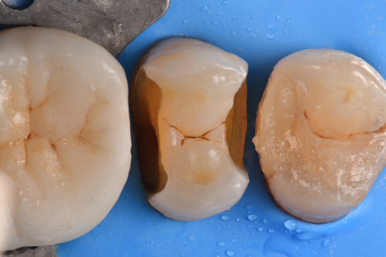 Radicular caries restored with Clearfil AP-X ES-2 Universal