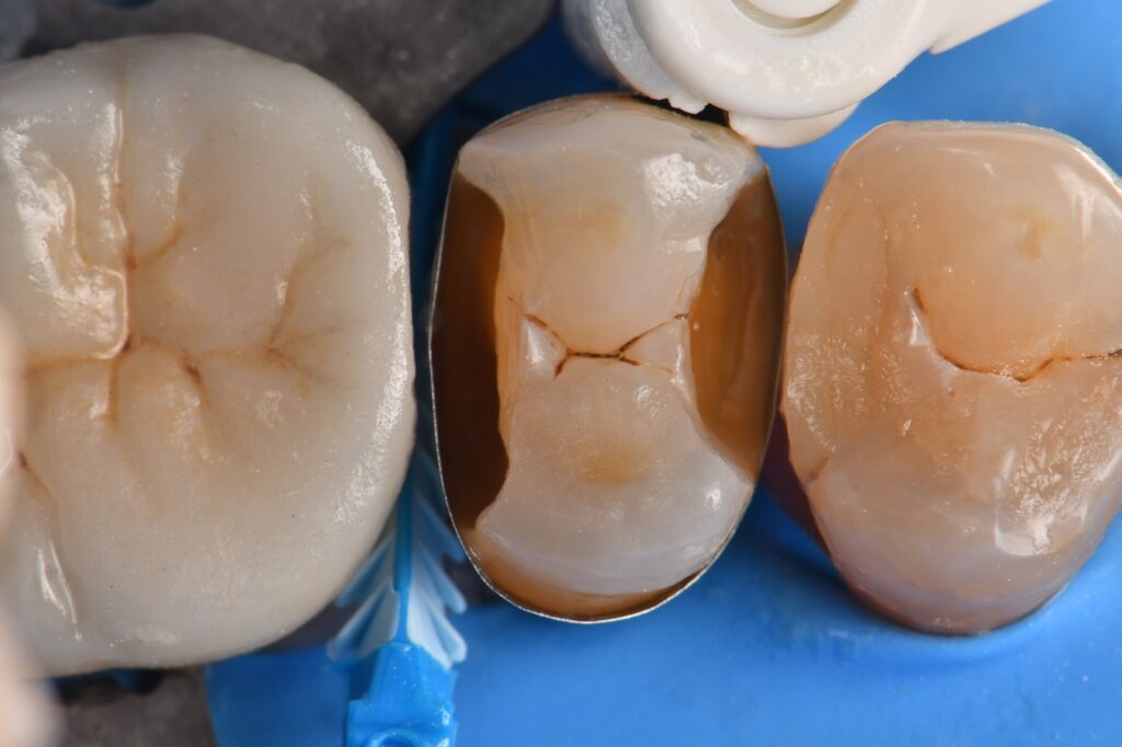 Radicular caries restored with Clearfil AP-X ES-2 Universal