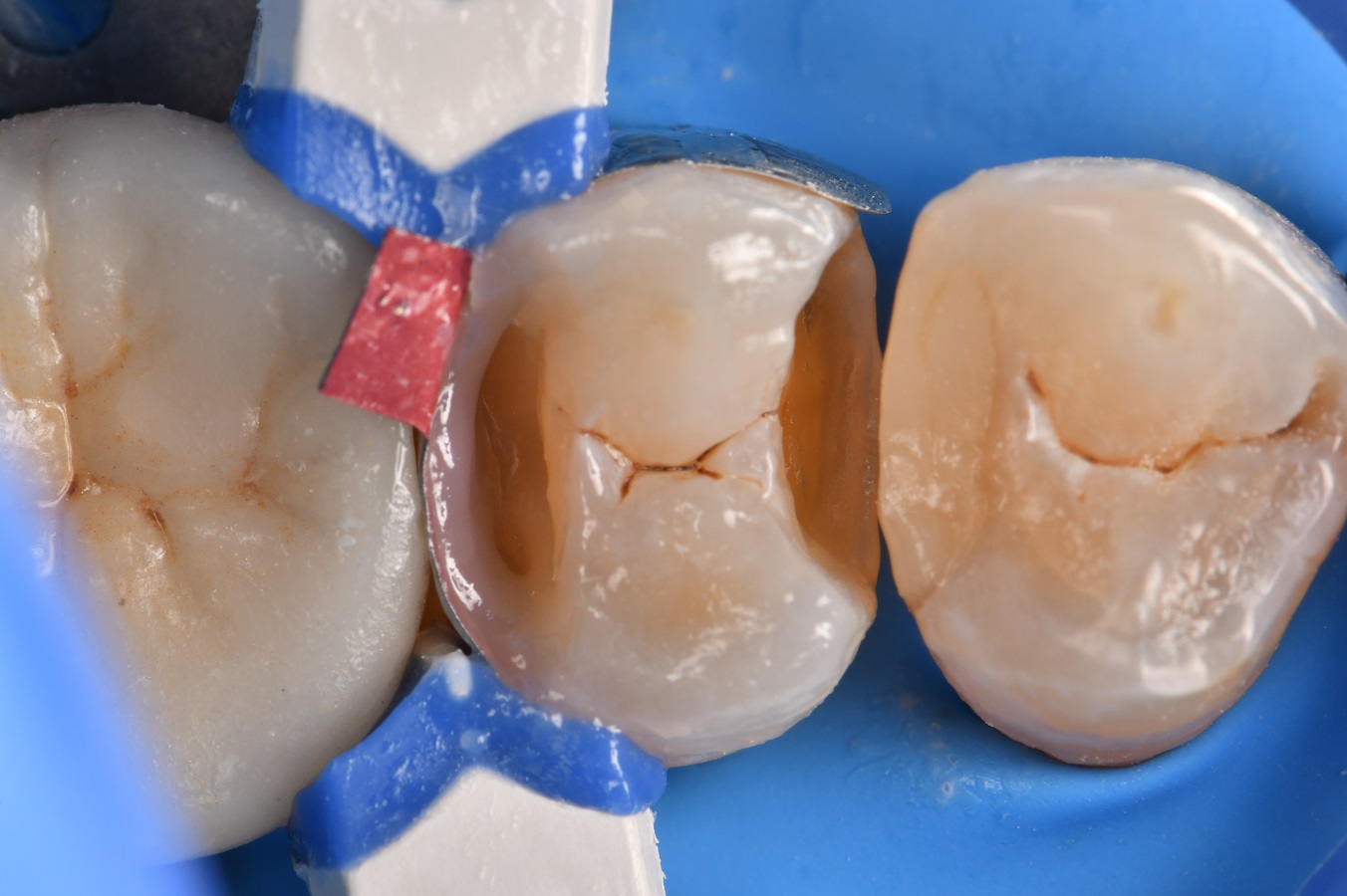 Radicular caries restored with Clearfil AP-X ES-2 Universal