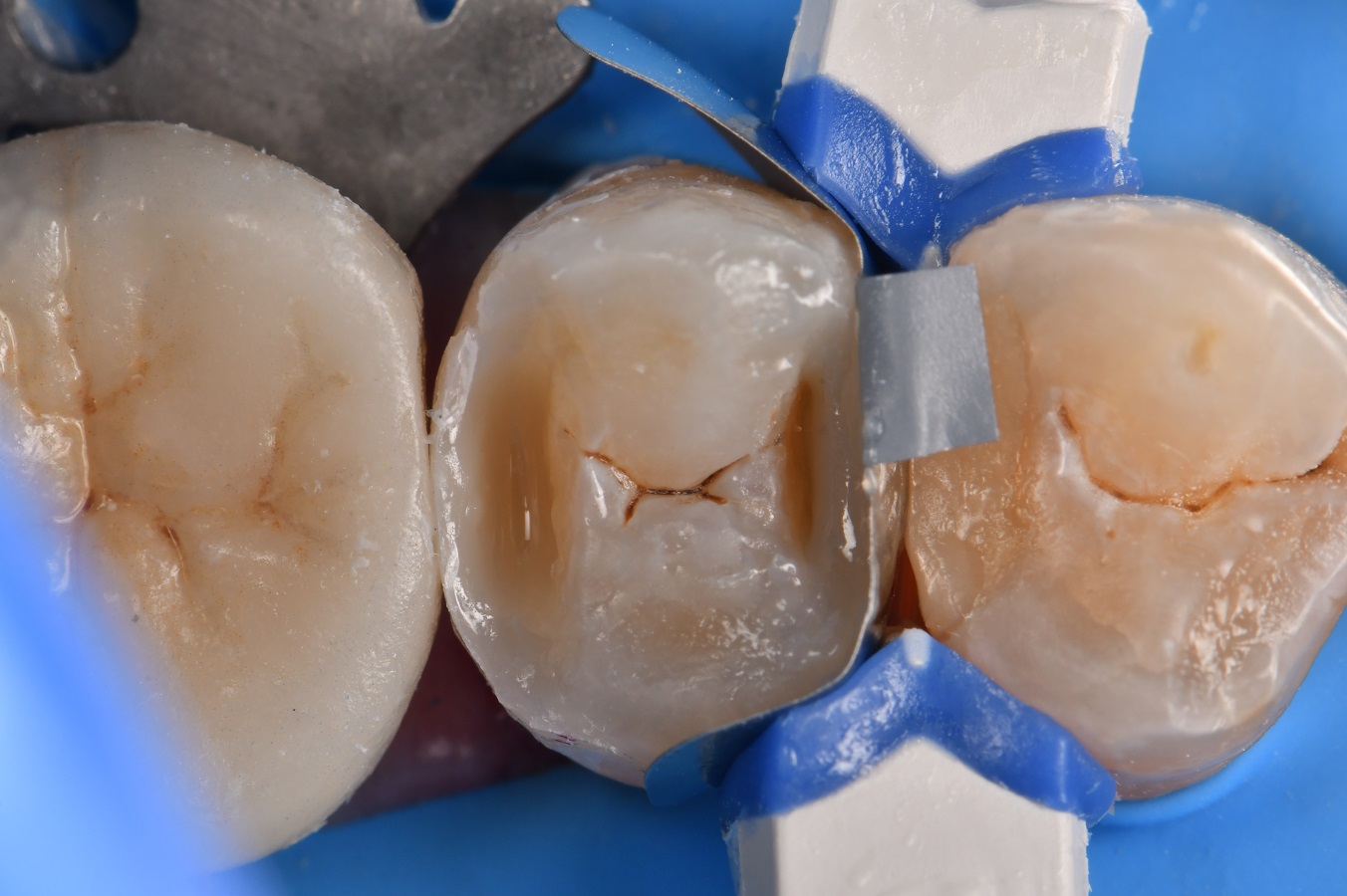Radicular caries restored with Clearfil AP-X ES-2 Universal