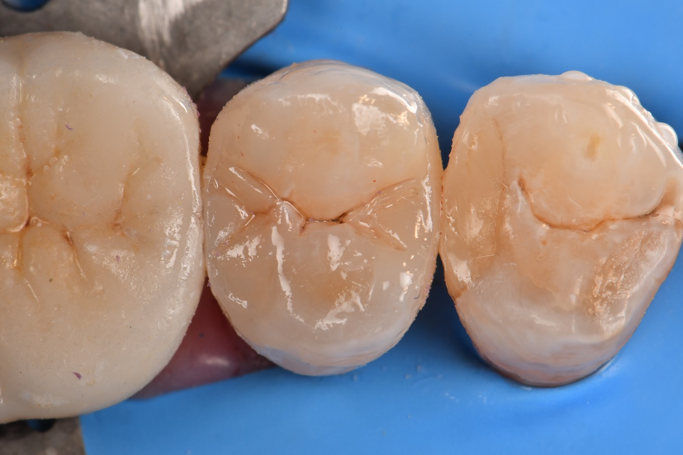 Radicular caries restored with Clearfil AP-X ES-2 Universal