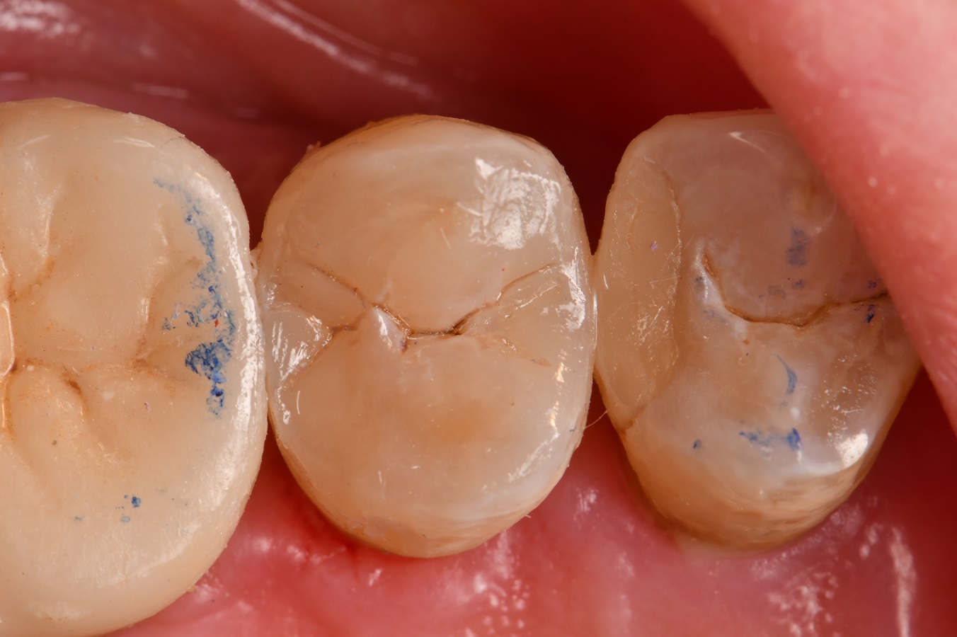 Radicular caries restored with Clearfil AP-X ES-2 Universal