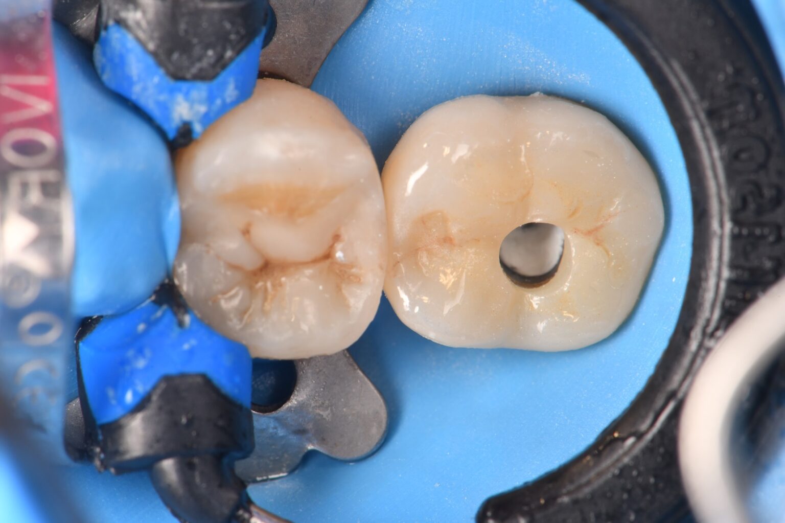 Reverse rubber dam isolation for an implant crown
