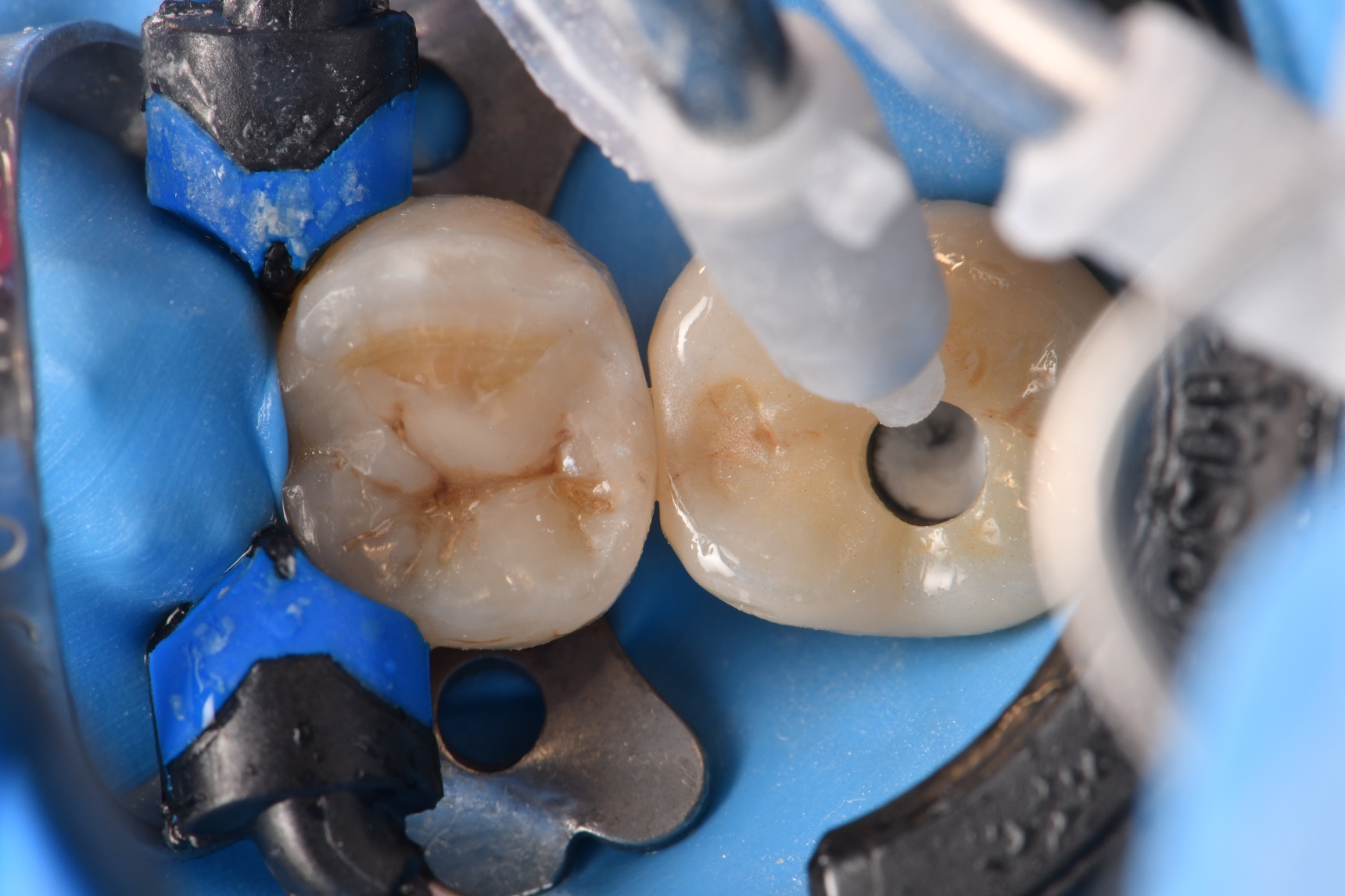 Reverse rubber dam isolation for an implant crown