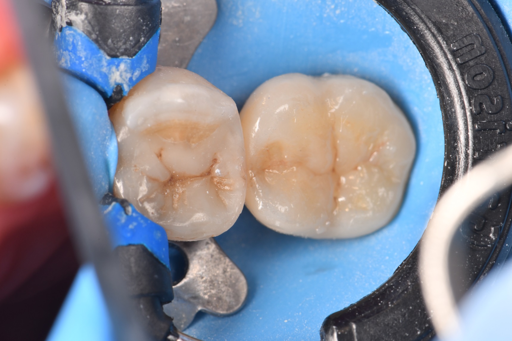 Reverse rubber dam isolation for an implant crown