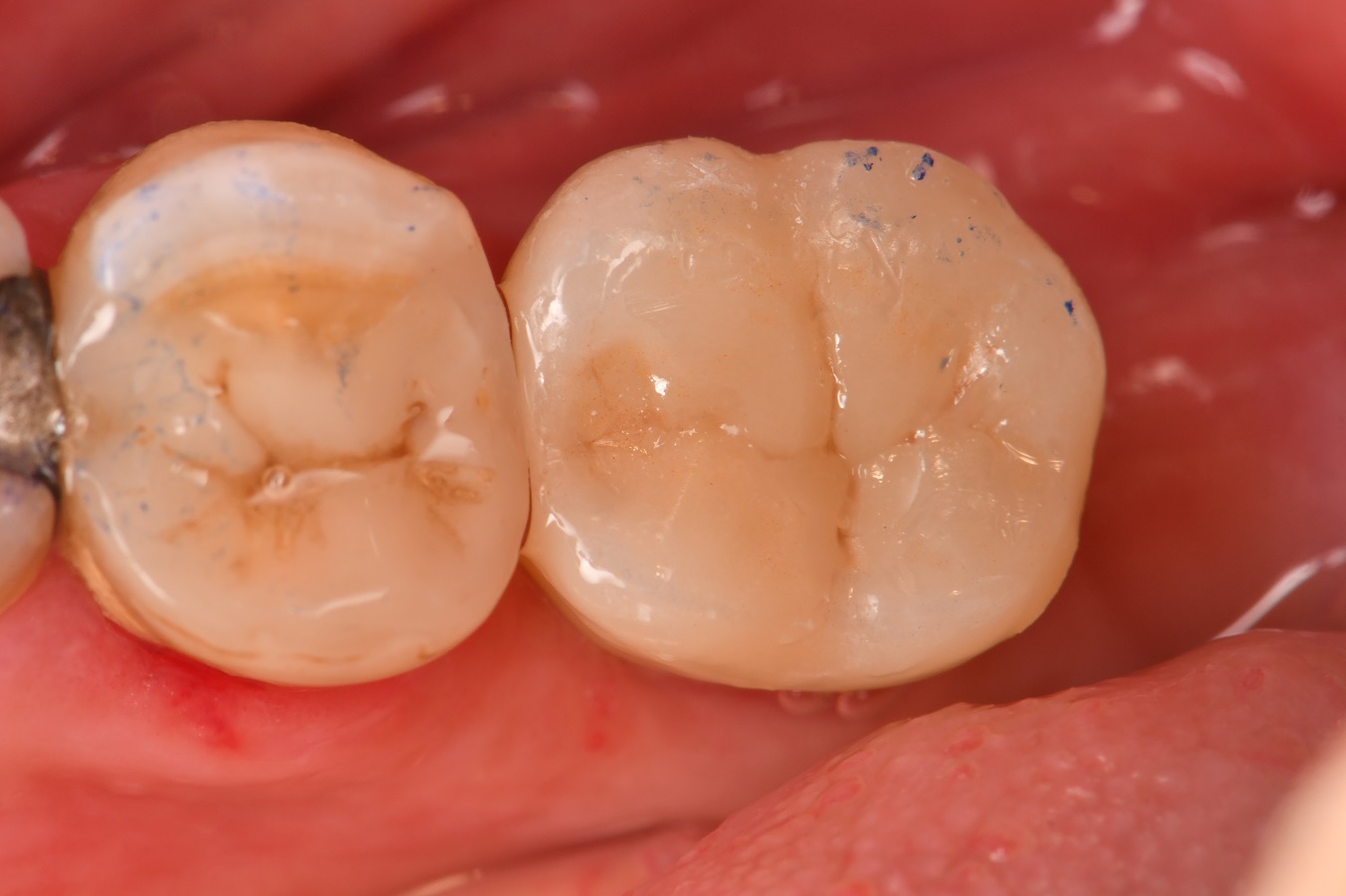 Reverse rubber dam isolation for an implant crown