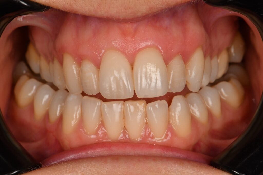 Ultradent Transcend Class VI restoration