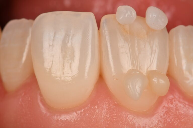 Ultradent Transcend Composite Veneer