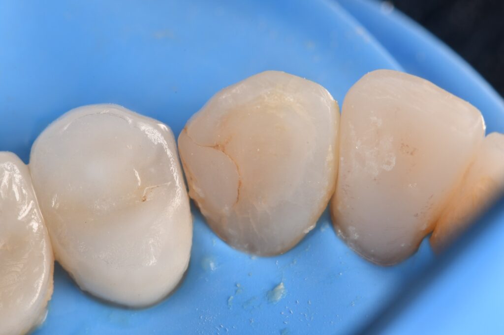 Class III with a composite featuring 187MPa flexural strength