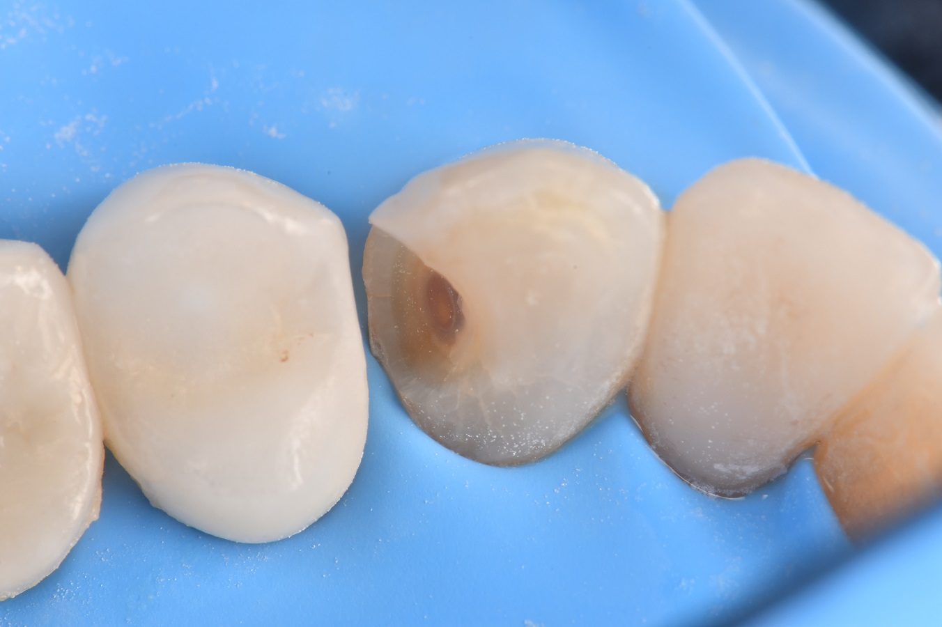 Class III with a composite featuring 187MPa flexural strength