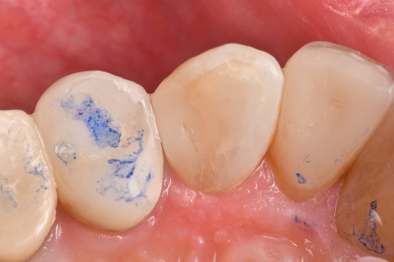 Class III with a composite featuring 187MPa flexural strength