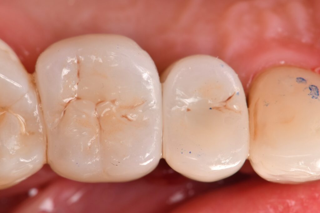 Implant Composite Screw Access Closures