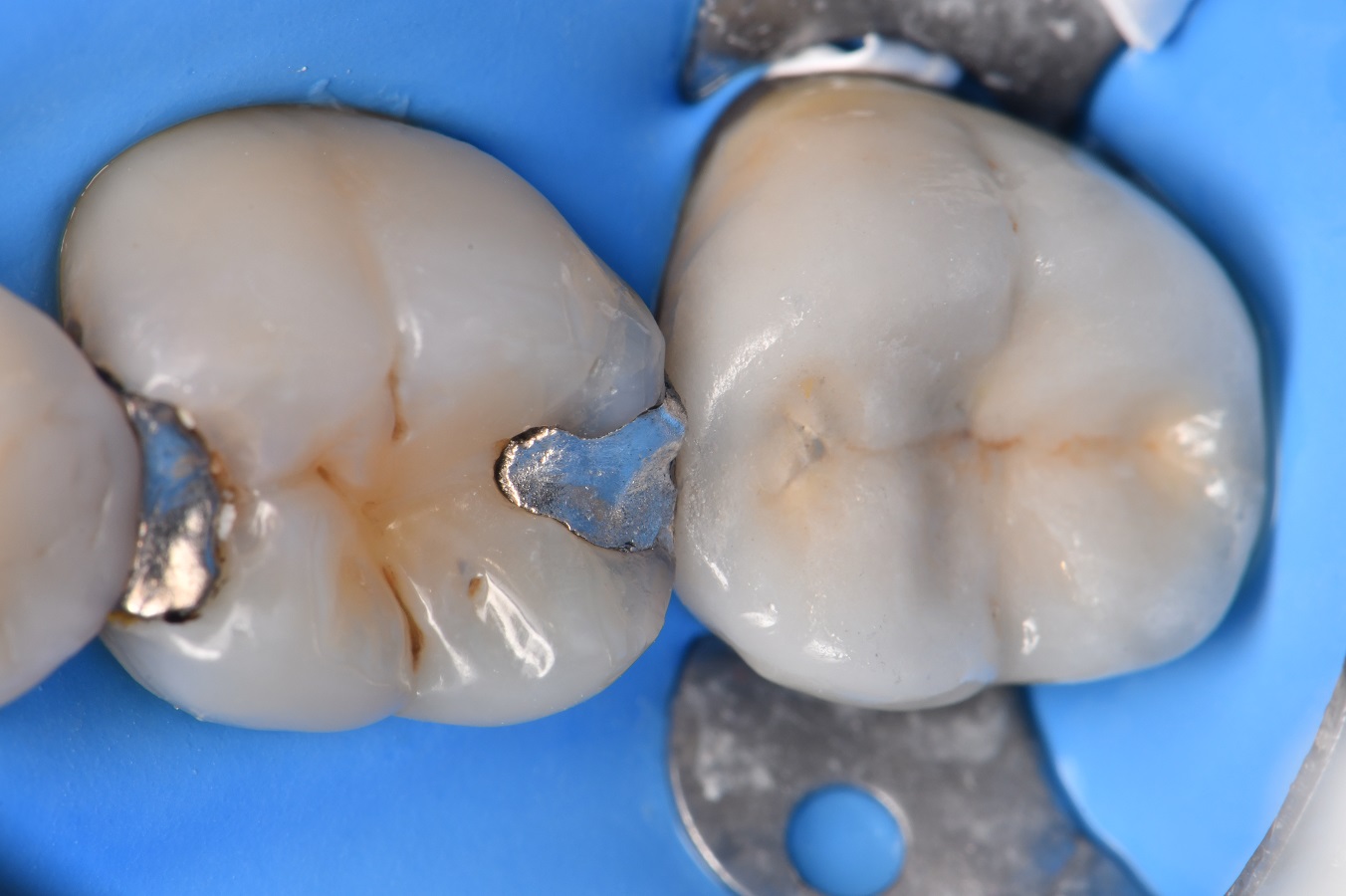 Amalgam Removal and Replacement Auckland