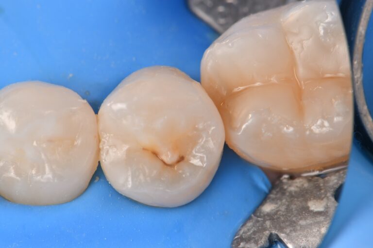Overerupted Premolar Restorative Tips