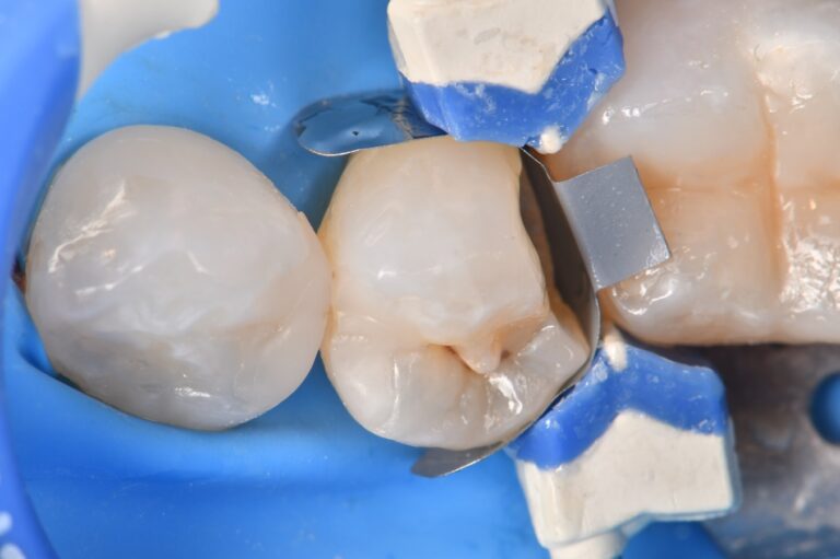 Overerupted Premolar Restorative Tips