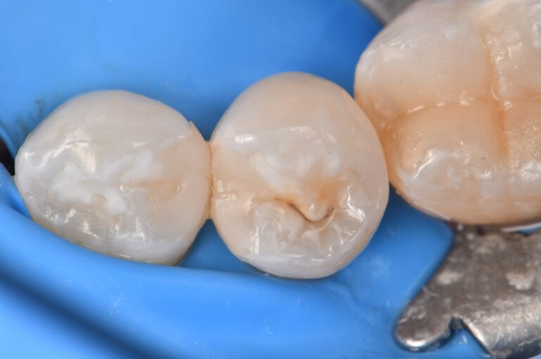 Overerupted Premolar Restorative Tips