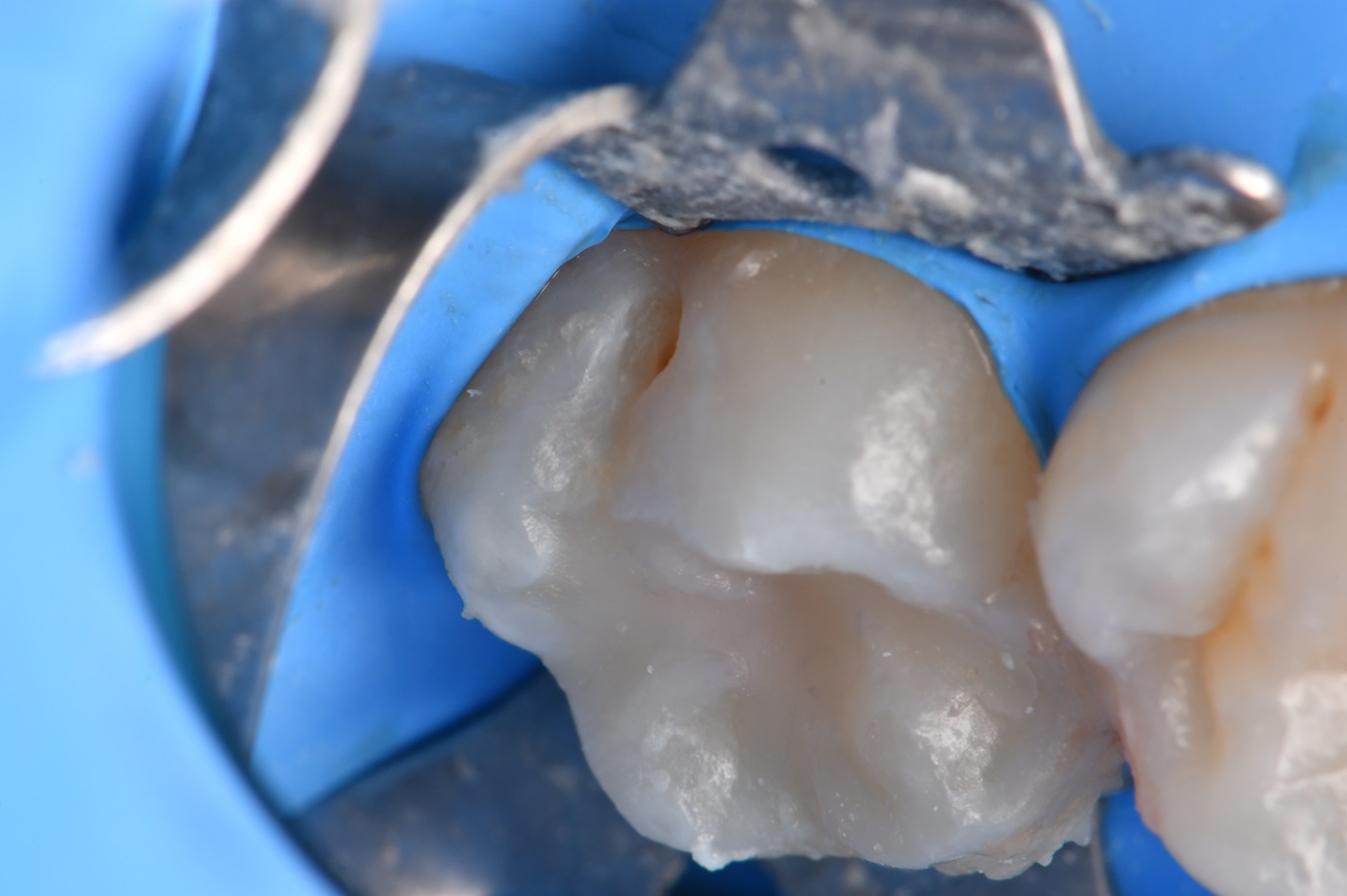 Palatal Pit Reconstruction with Clearfil Majesty
