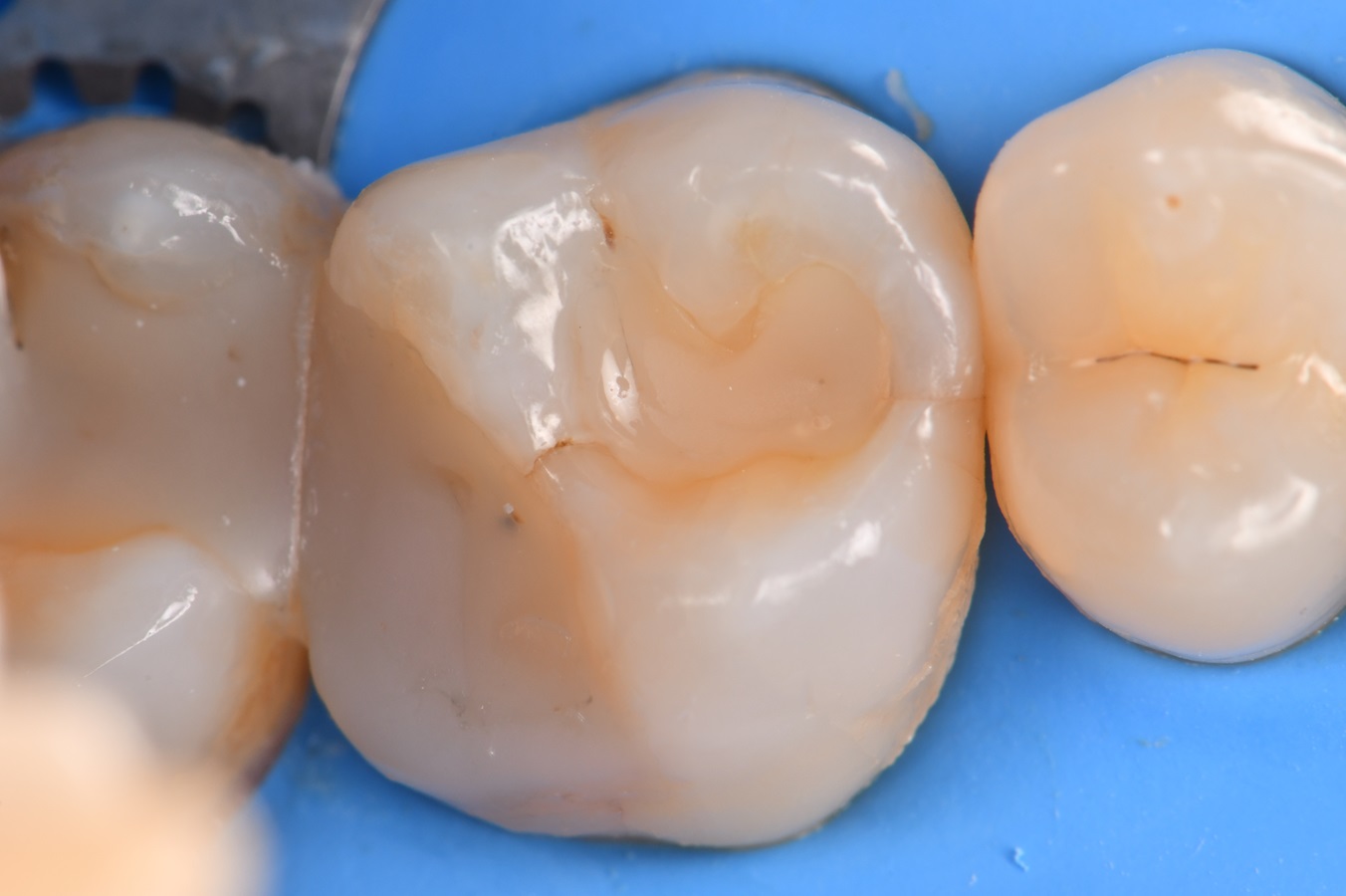 Clearfil Majesty ES-2 Universal and Ever-X Flow