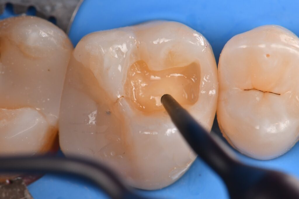 Clearfil Majesty ES-2 Universal and Ever-X Flow