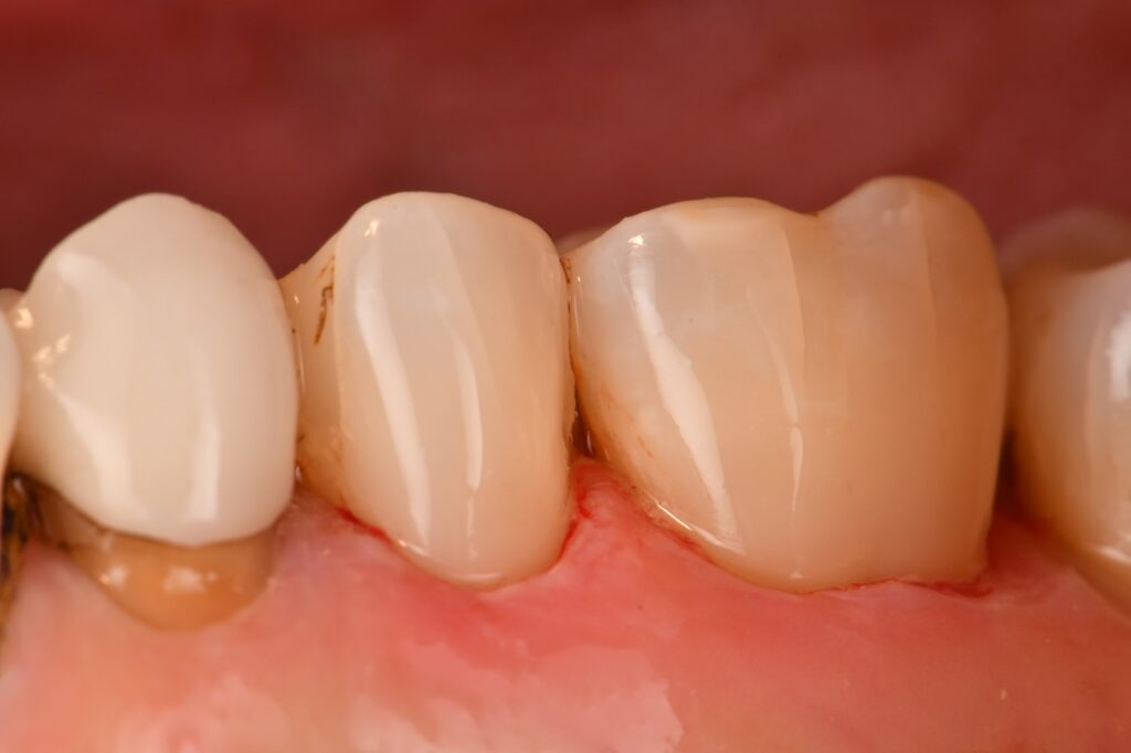 GC Essentia U used in Class V situations