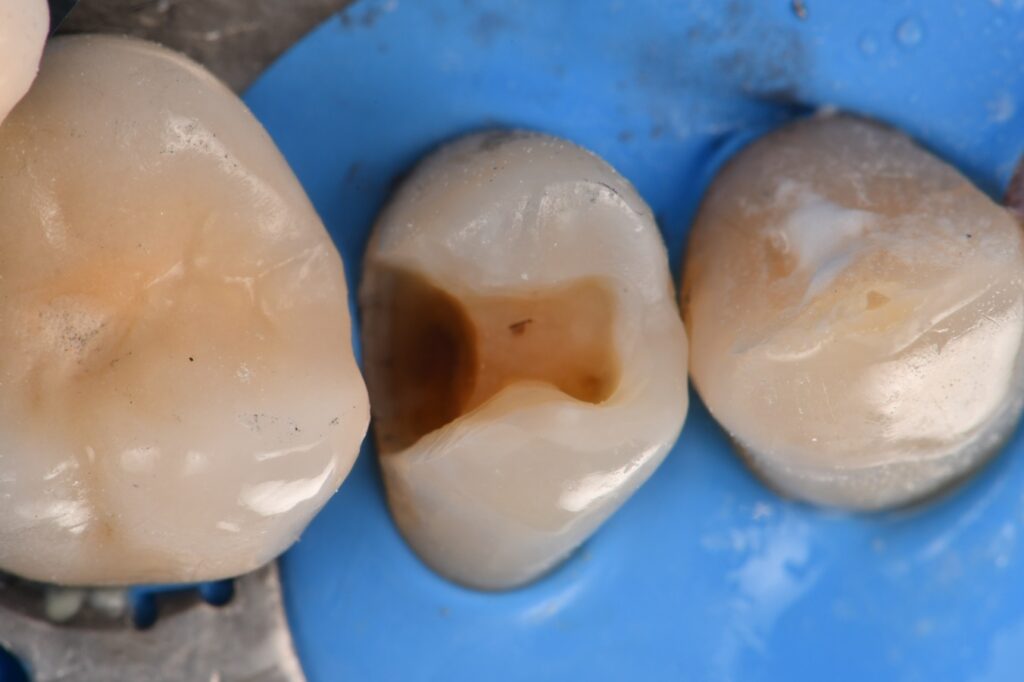 Amalgam replacement with Clearfil Majesty