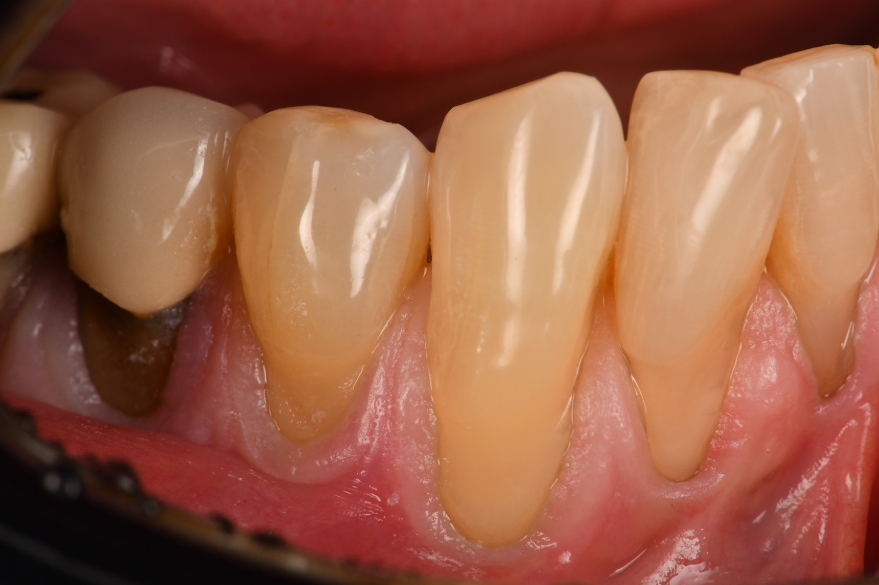 Cervical Abrasion Lesions on Root Surface